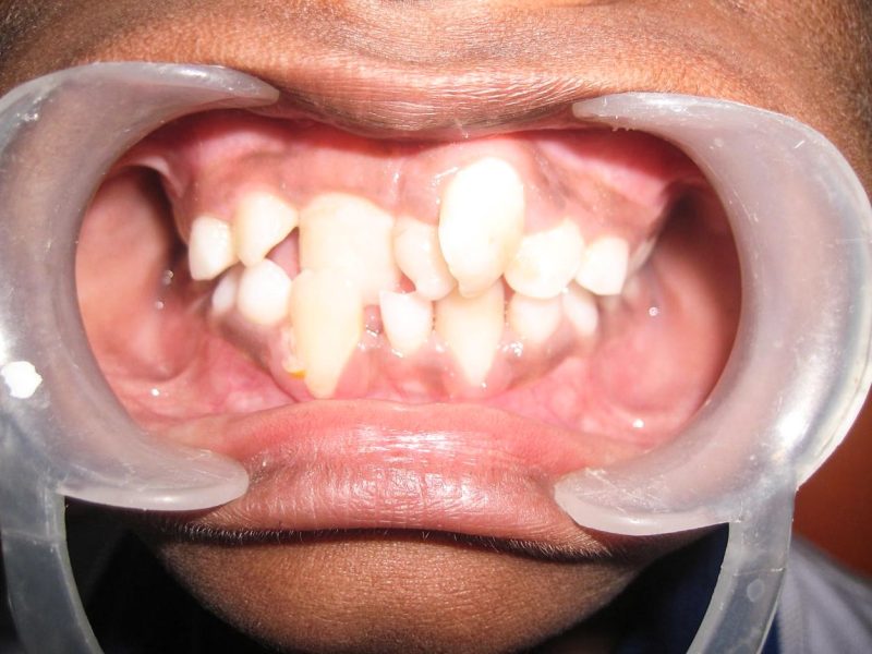 Hyperdontia - Too many teeth - Dr. Salim Kapadia Dental Centre