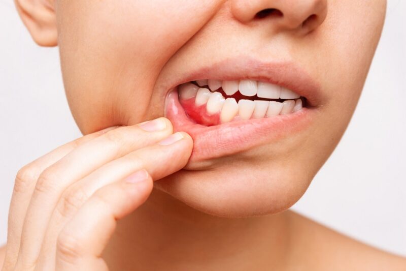 How to keep your gums healthy - Dr. Salim Kapadia Dental Centre